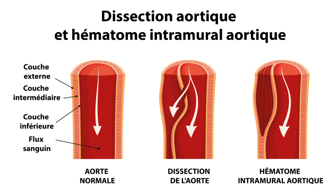 Aorte Thoracique : Plusieurs maladies peuvent l'affecter