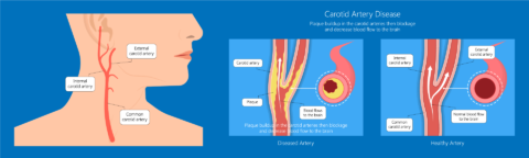STÉNOSE CAROTIDIENNE : Quels sont les symptômes