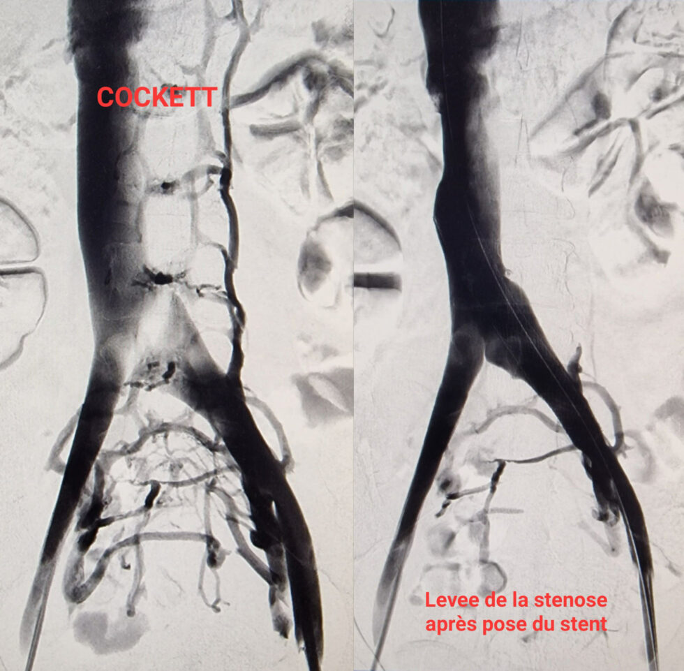Syndrome de Cockett (ou syndrome de May-Thurner)